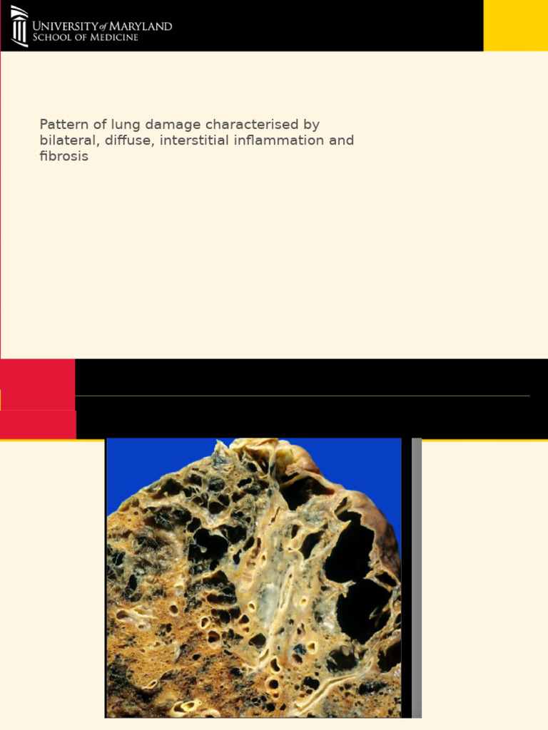 Pattern of Lung Damage Characterised by Bilateral, Diffuse ...