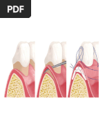 Tunneled Coronally Advanced Flap For The Treatment of Isolated Gingival ...