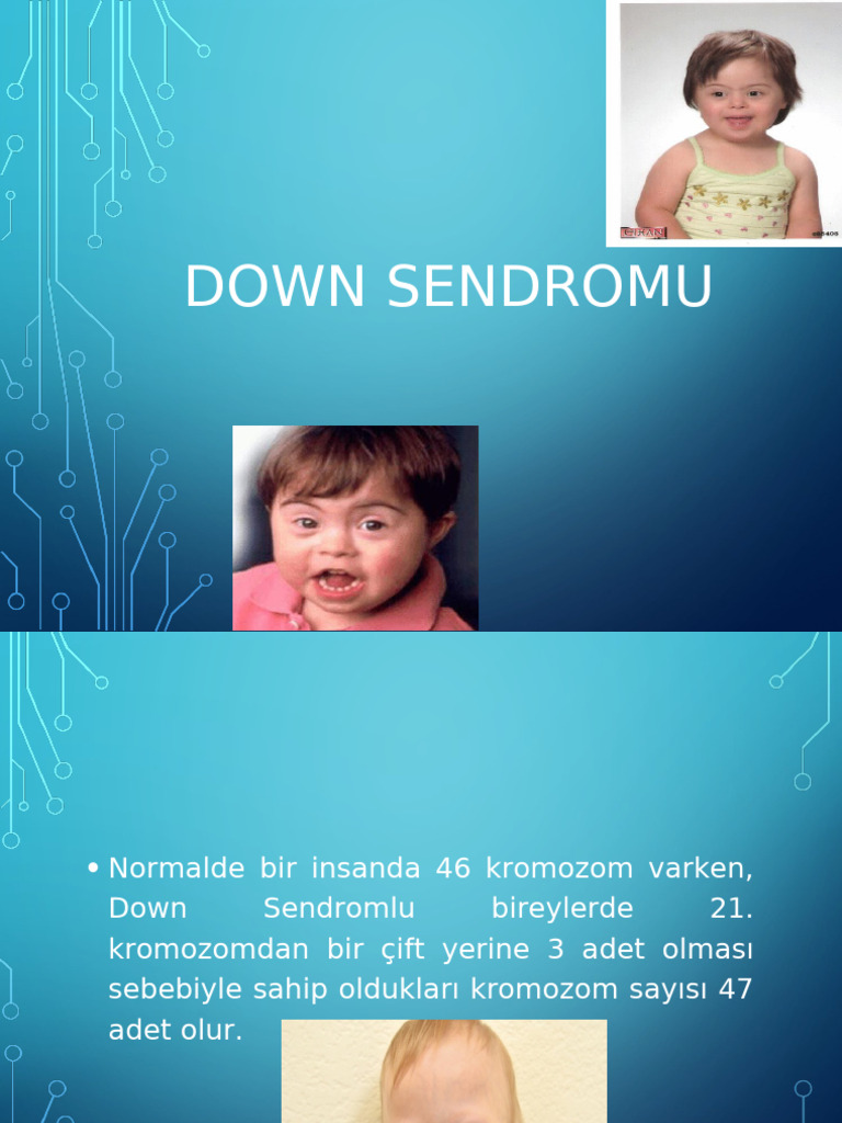 Down Sendromu | PDF