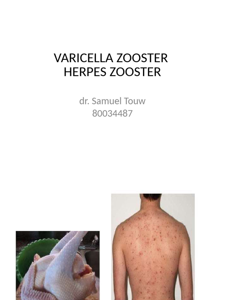 Varicella | PDF
