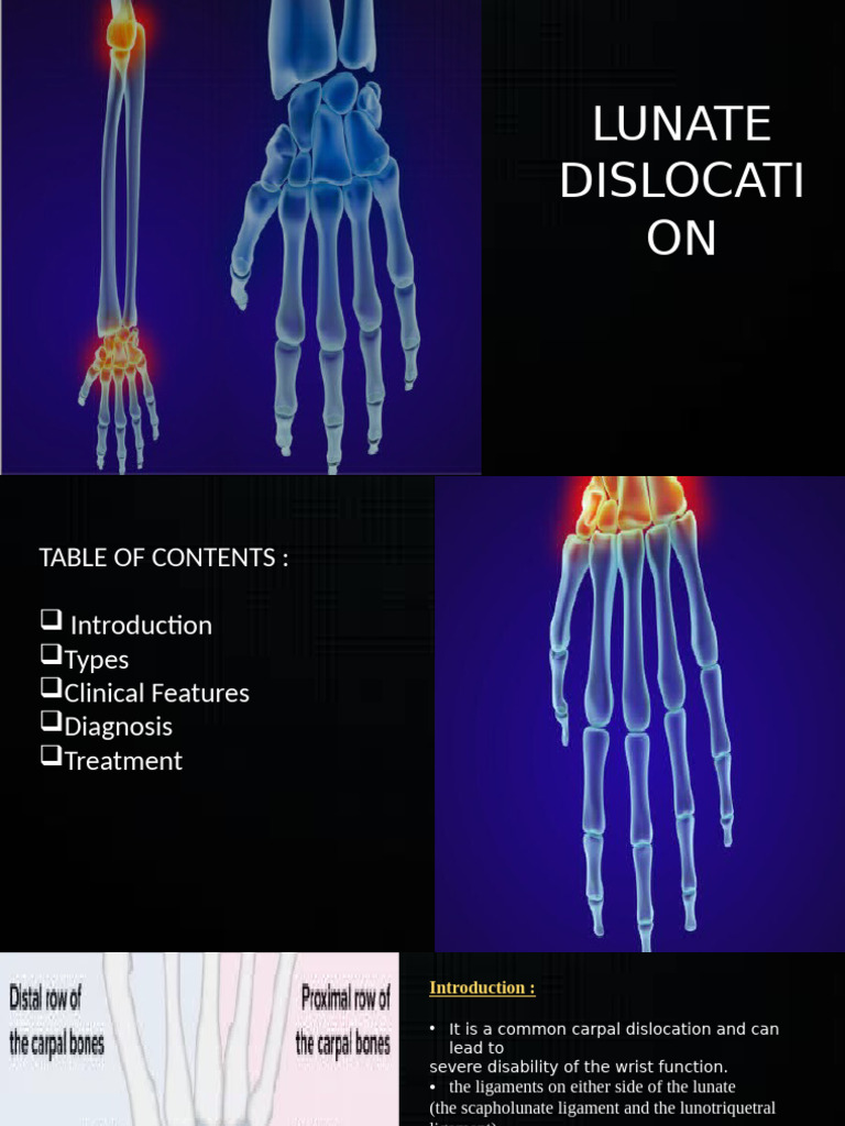 Lunate Dislocation: Types, Diagnosis, Treatment | PDF