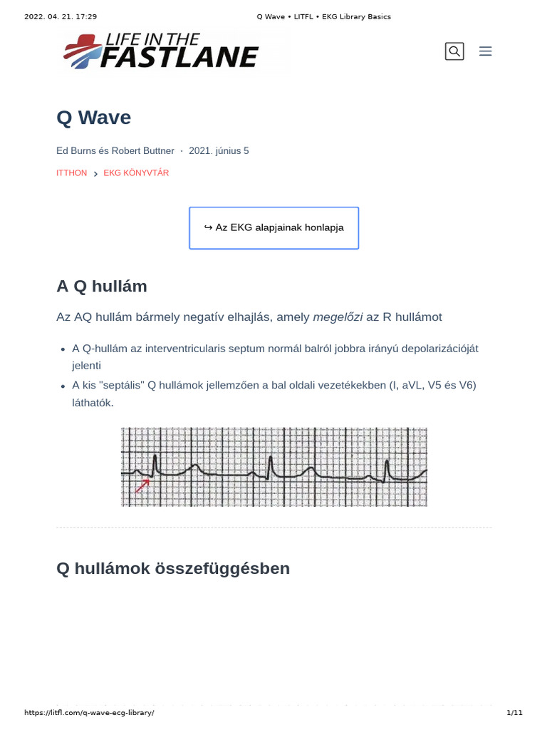 Q Wave - LITFL - EKG Library Basics | PDF