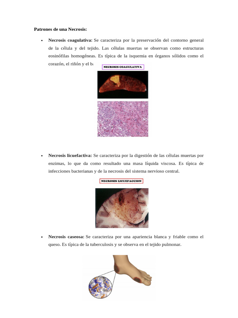 Tipos de Necrosis y sus Características | PDF | Sangre | Necrosis