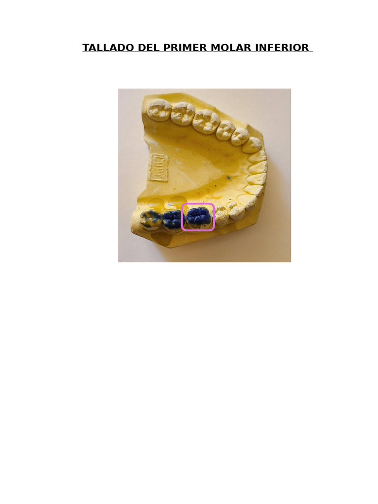 Tallado Del 2do Molar Inferior | PDF