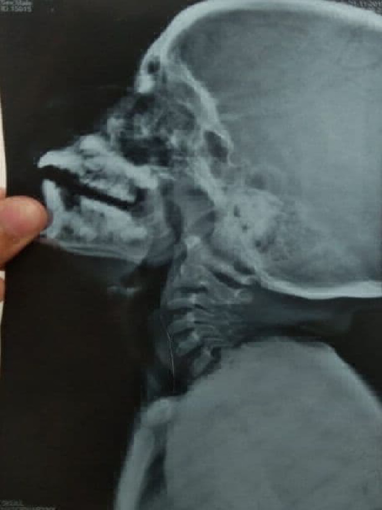 X-Ray ENT, Complete AP and Pa View Xrays | PDF