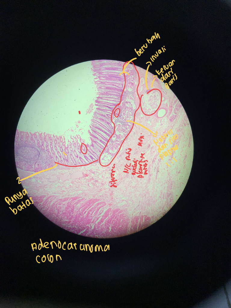 Patologi Anatomi Neoplasma | PDF