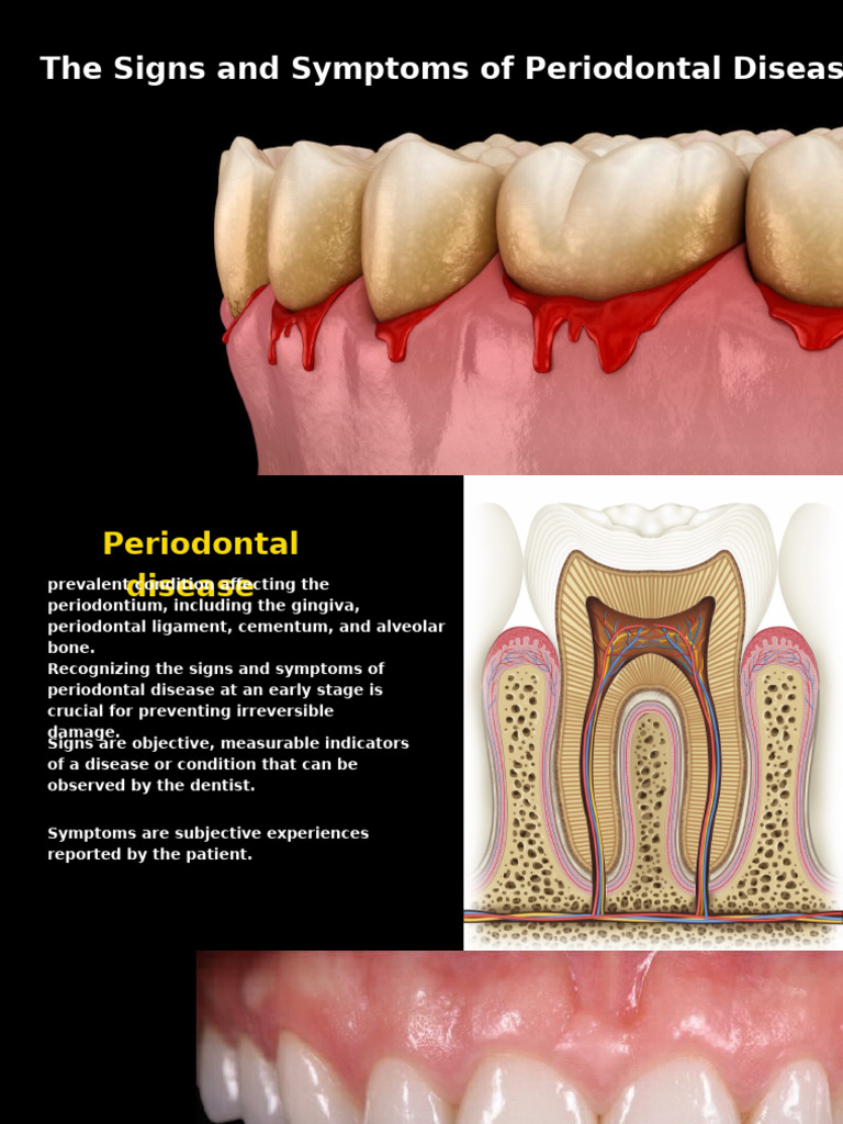 Signs and Symptoms of Periodontitis | PDF | Periodontology | Medical ...