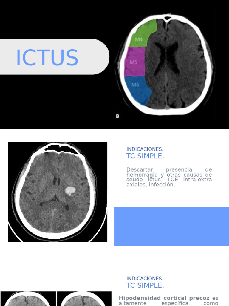 ICTUS | PDF