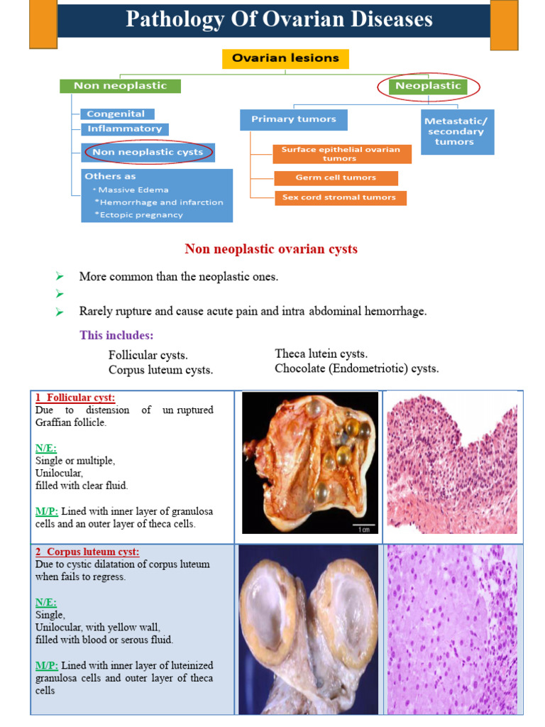 L28 Ovarian Diseases HANDOUT (Pathology-3) | PDF | Ovarian Cancer | Cancer