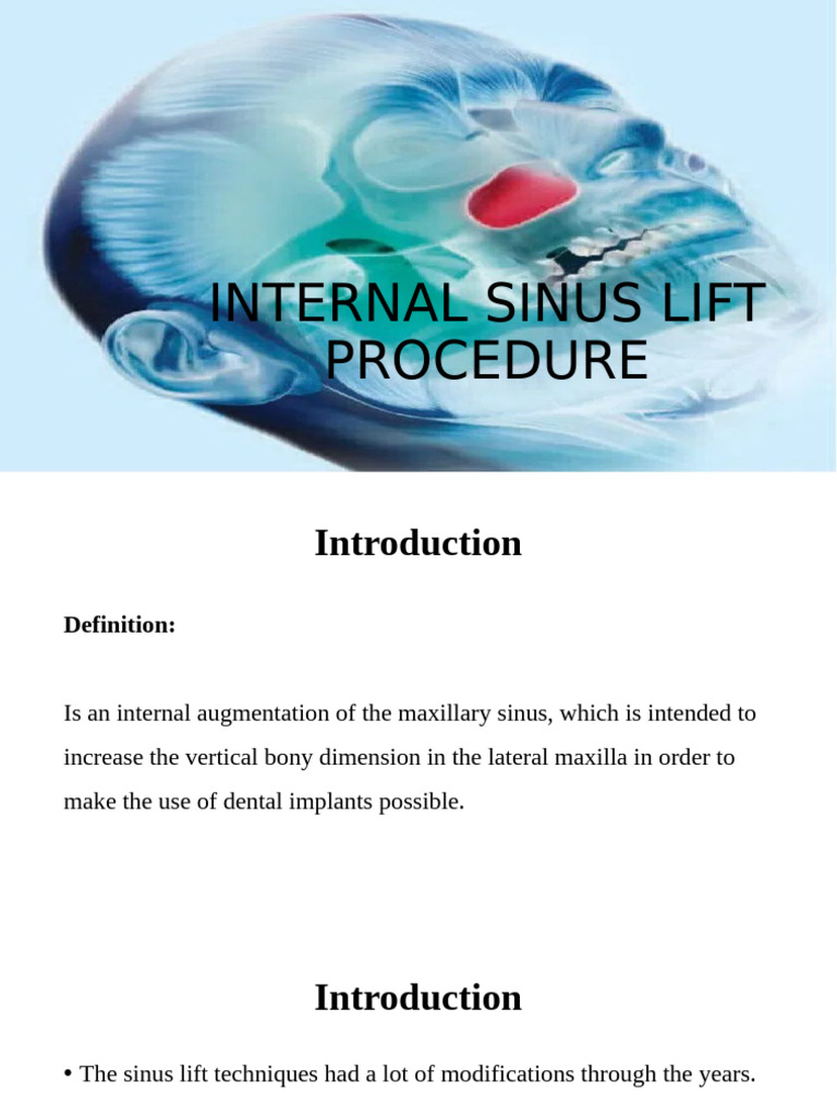 Internal Sinus Lifting | PDF | Dental Implant | Surgical Specialties