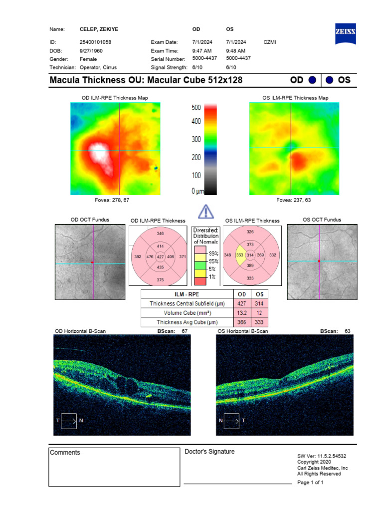 OS OD Macula Thickness OU: Macular Cube 512x128 | PDF