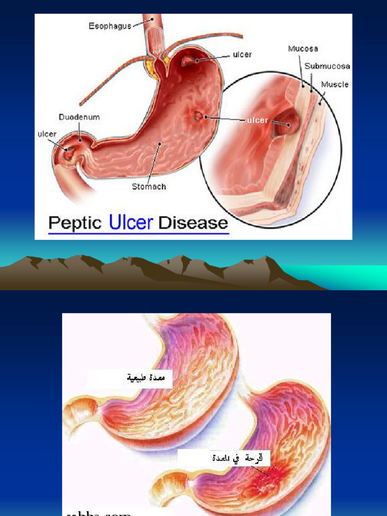 Peptic-Ulcer | PDF