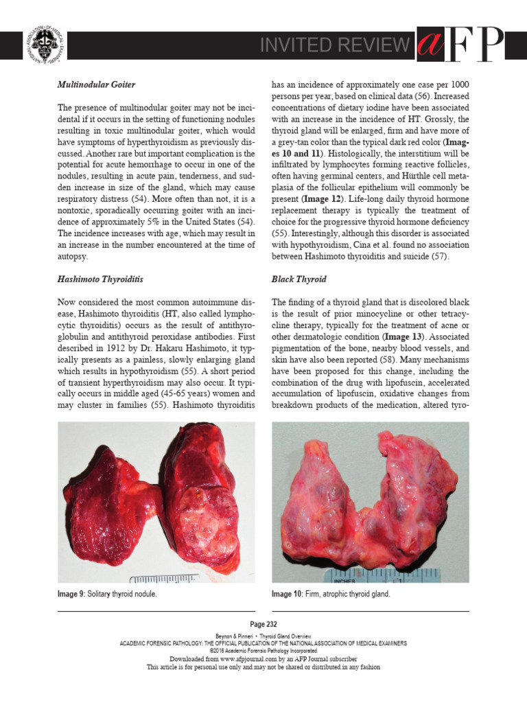 Multinodular Goiter and Hashimoto's Overview | PDF | Thyroid ...