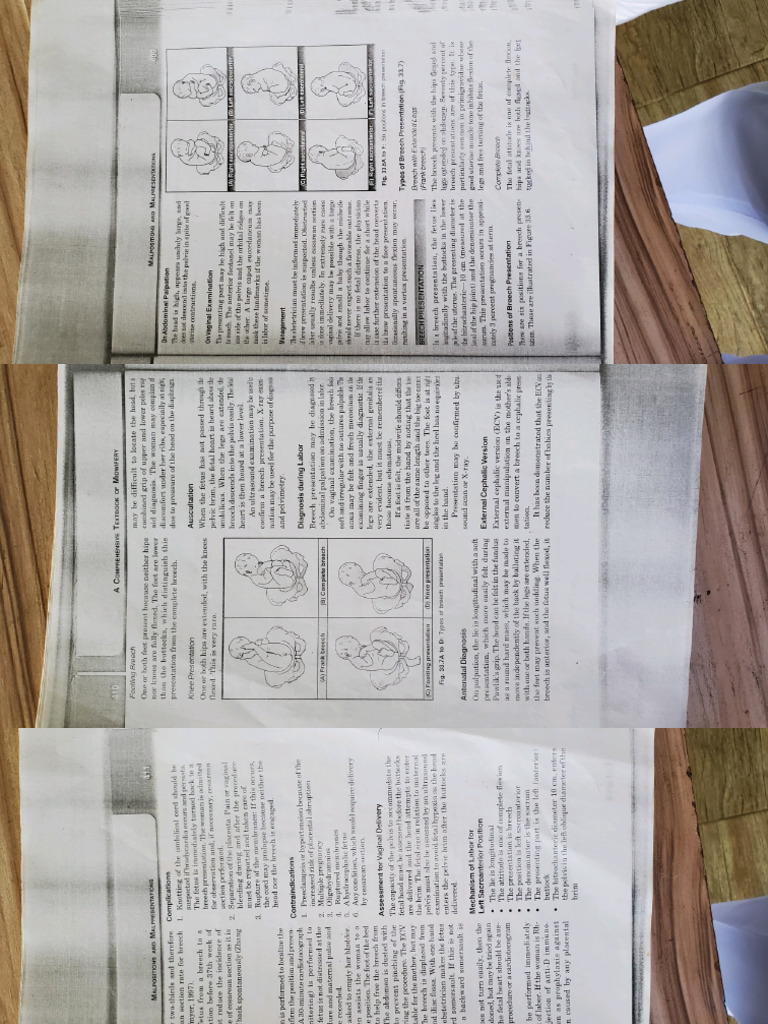 Breech in Pregnancy | PDF