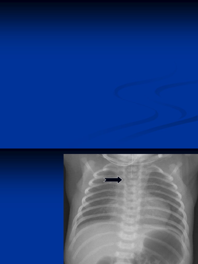 Atrezie Esofag | PDF