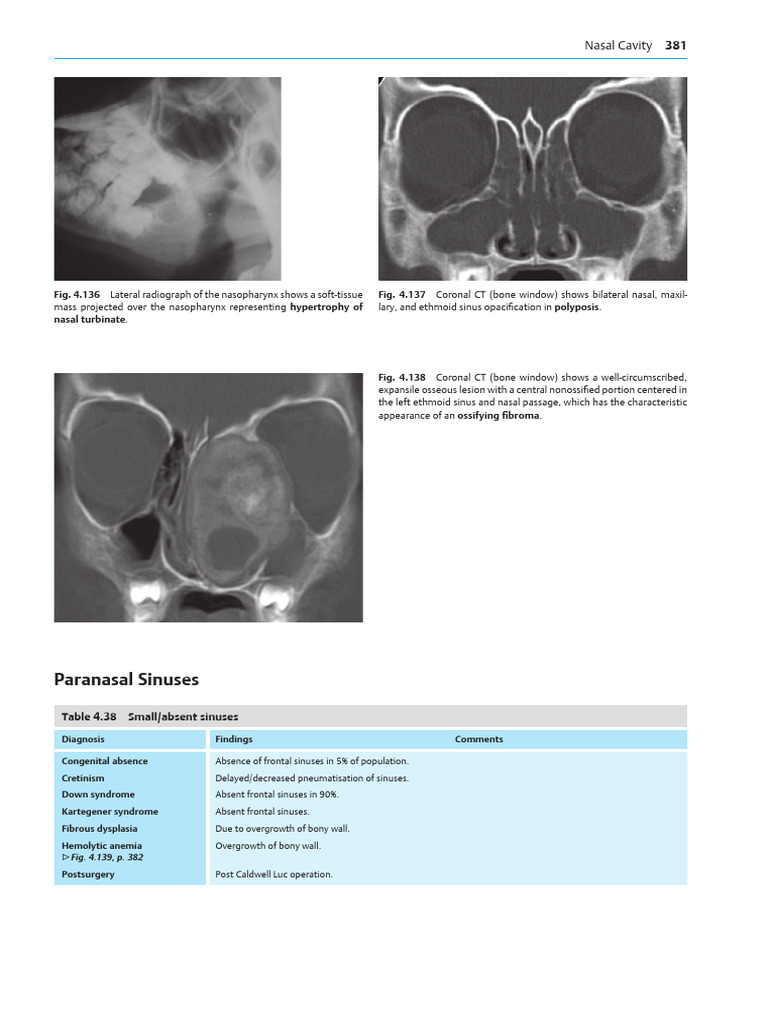 Paranasal Sinuses: Fig. 4.136 Hypertrophy of Nasal Turbinate Fig. 4.137 ...