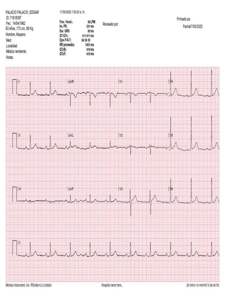 RR Promedio: 1001 Ms QTCB: 410 Ms QTCF: 410 MS: I Avr V1 V4 | PDF