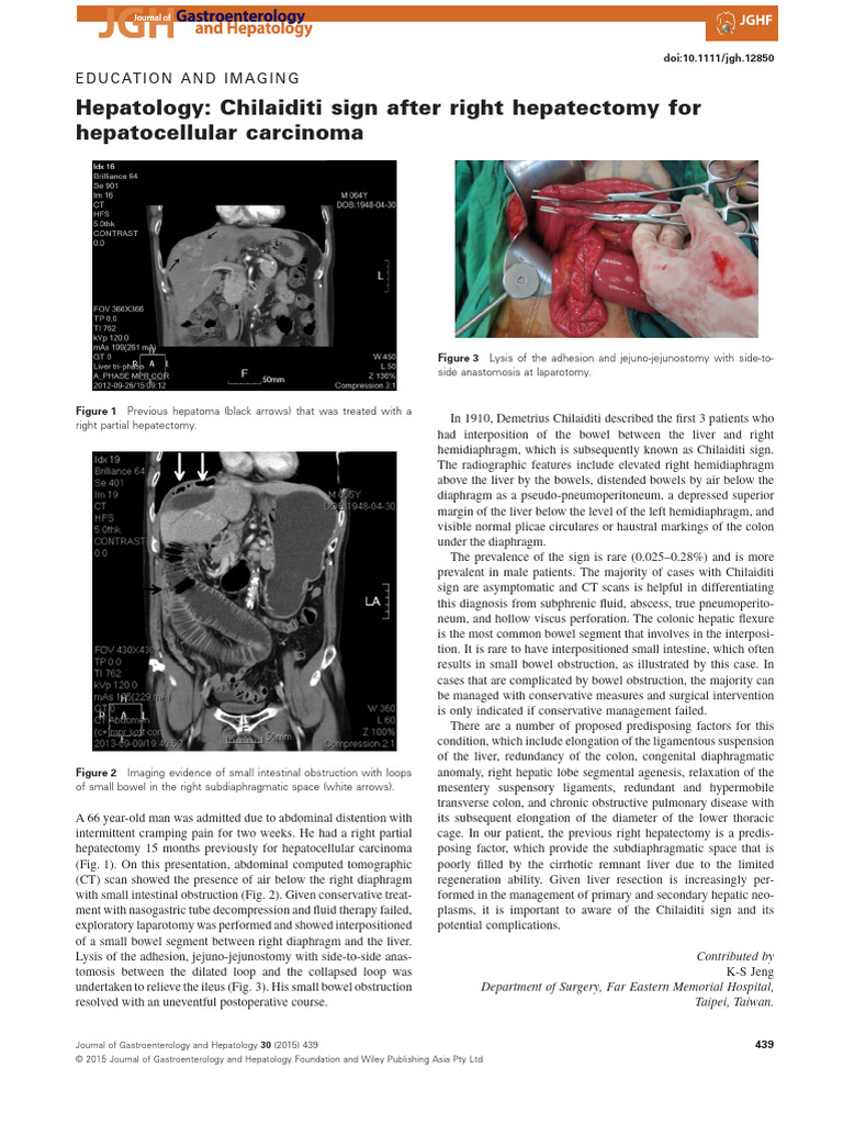 Chilaiditi Sign Post-Hepatectomy Case Study | PDF | Digestive System ...