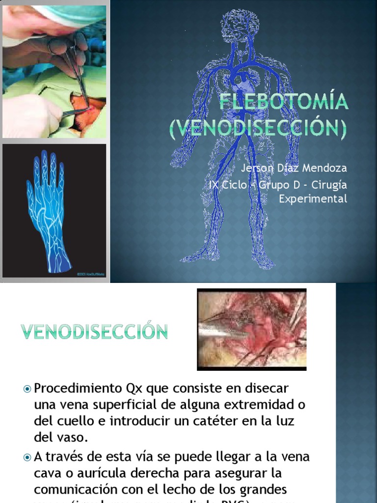 Flebotomía (Venodisección) | Terapia intravenosa | Ciencias de la Salud