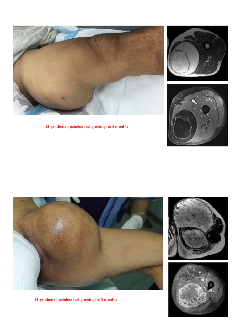 Soft Tissue Sarcoma | PDF | Sarcoma | Medicine
