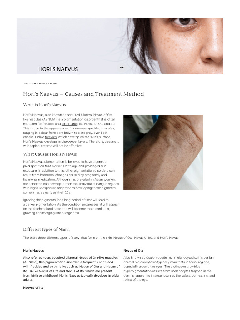 Hori's Nevus - Nevus of Ota - Treatment Options For This Pigmentation ...