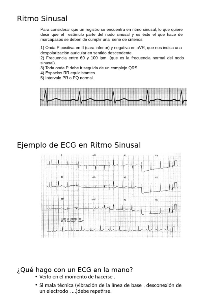 Criterios de Ritmo Sinusal | PDF