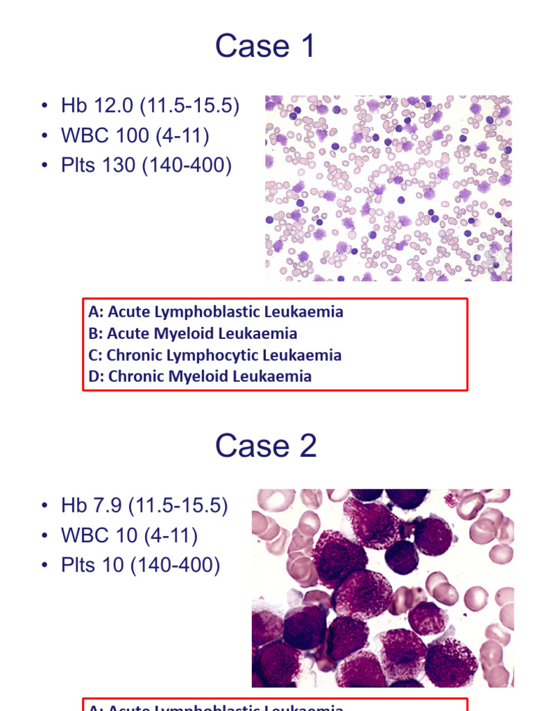 Case Studies On Haematologic Malignancies | PDF