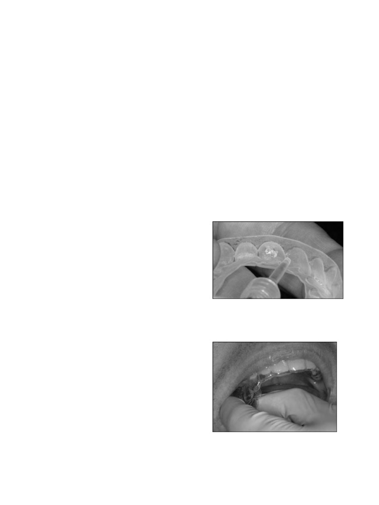 Bleaching Instructions Sensitive Teeth7.1.16 | PDF | Mouth | Dentistry ...