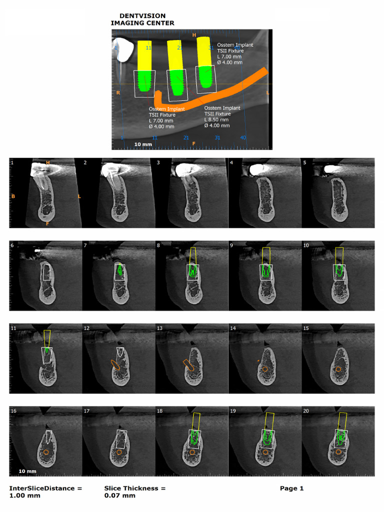 Sample of Implant Placement | PDF
