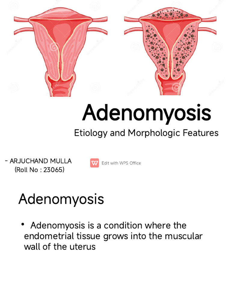 Adenomyosis | PDF