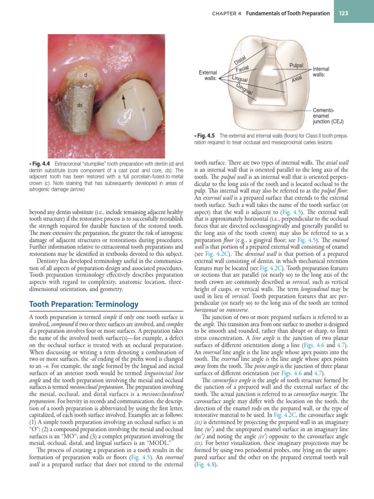 Tooth Preparation: Terminology: External Walls: Internal Walls: Pulpal ...