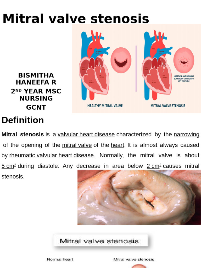 Mitral Valve Stenosis | PDF | Circulatory System | Medical Specialties