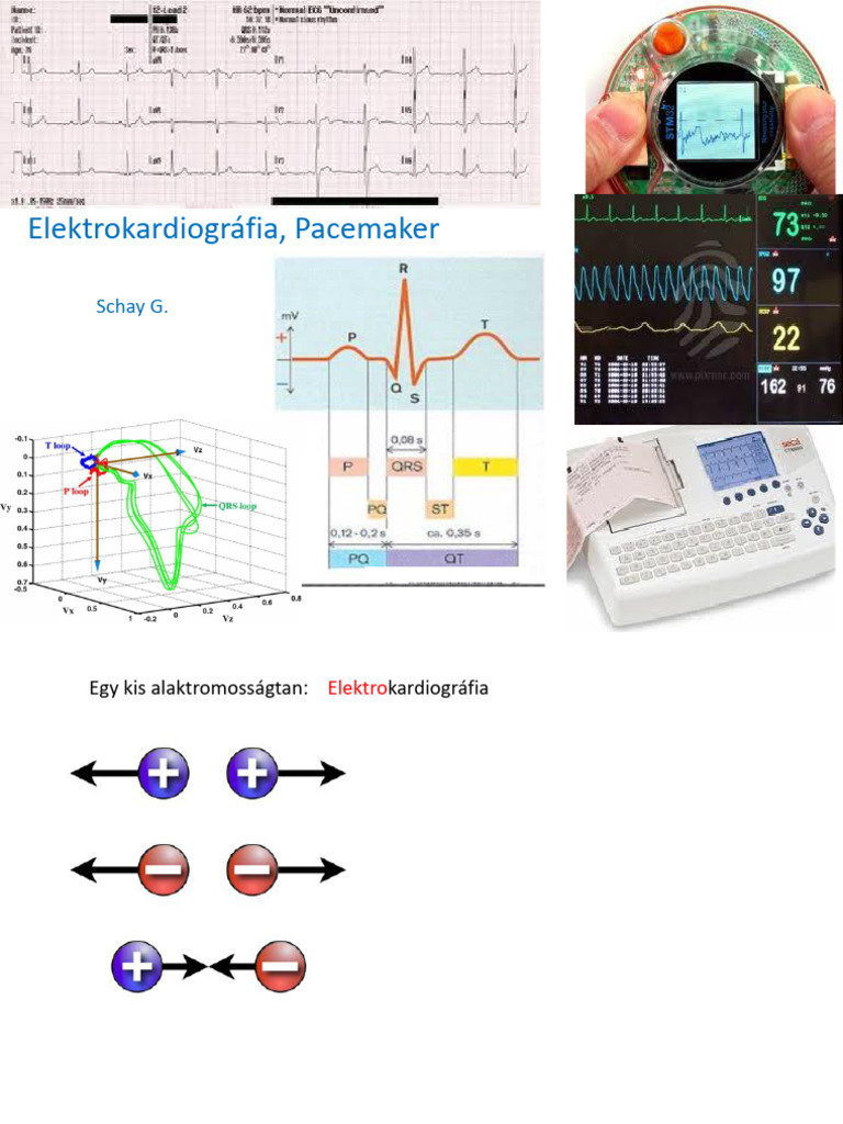EKG Pacemaker HU | PDF