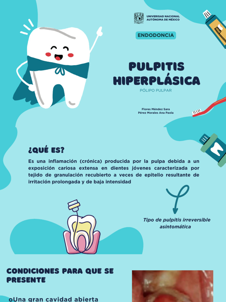 5 - Pulpitis - Hiperplasica | PDF | Tejido (biología) | Medicina CLINICA