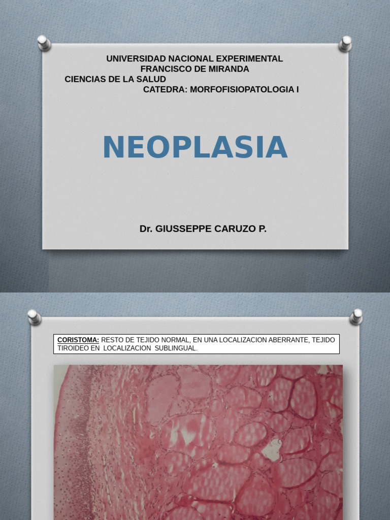 Neoplasia | PDF | Adenocarcinoma | Neoplasias