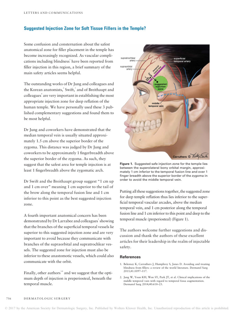 Suggessted Injection Zone For Soft Tissue Fillers in The Temple | PDF ...