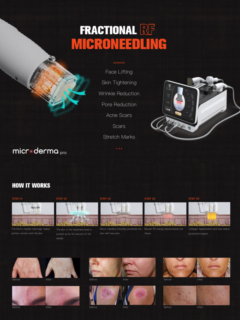 Advanced RF Microneedling System | PDF | Scar | Skin