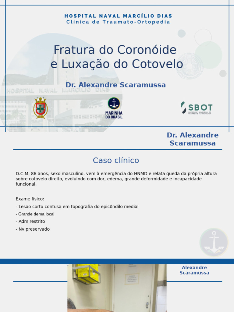 Fratura Do Coronoide + Luxação Do Cotovelo + Triade Terrivel | PDF ...