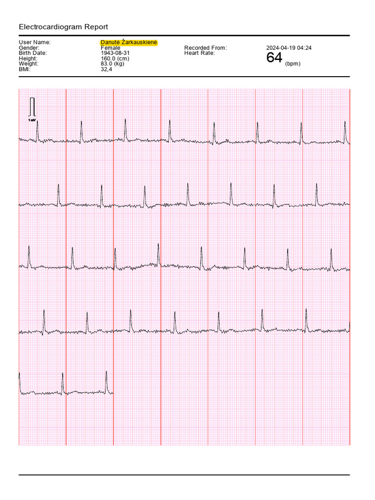 ECG Report | PDF