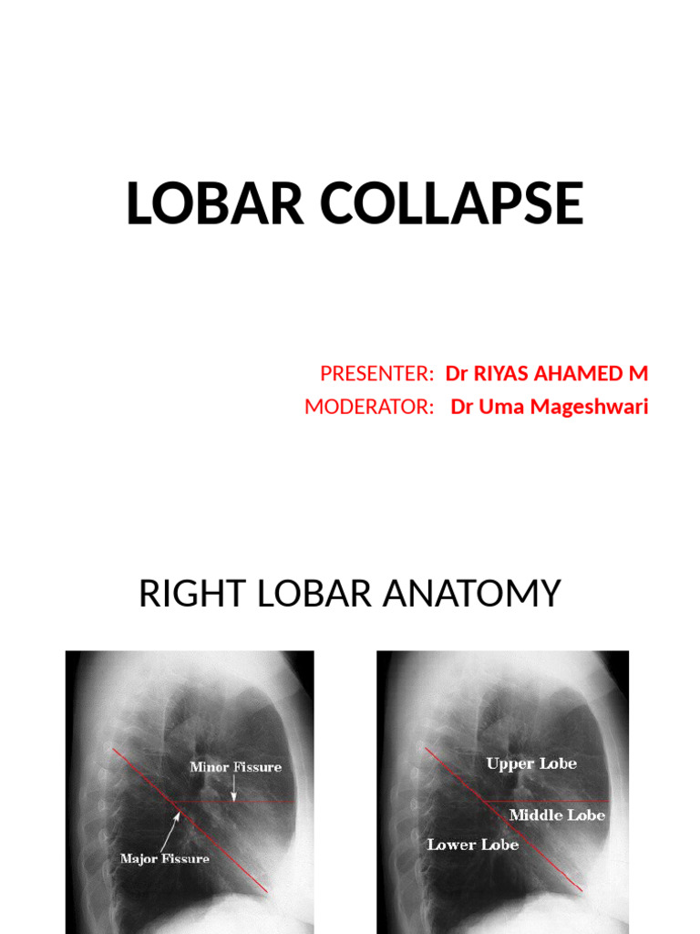 Lobar Collapse Radiology | PDF | Lung | Thorax (Human Anatomy)
