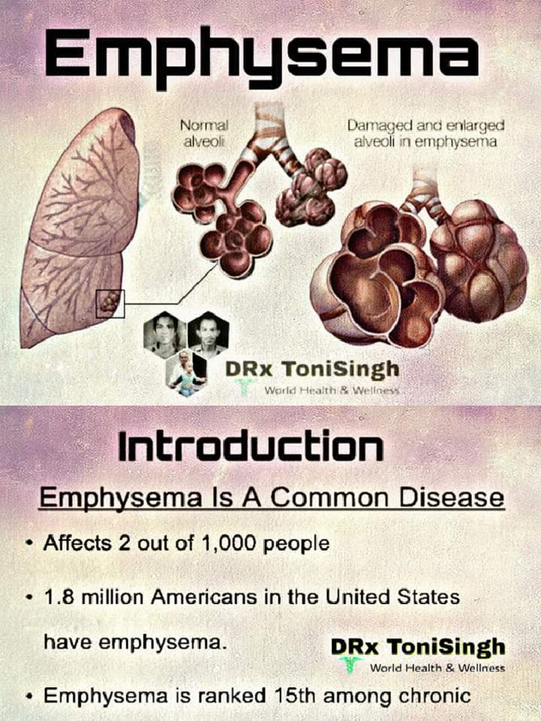 Emphysema | PDF