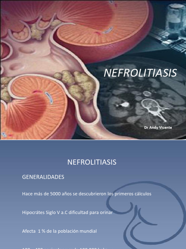 Tema 16 Nefrolitiasis | PDF | Orina | Especialidades Medicas