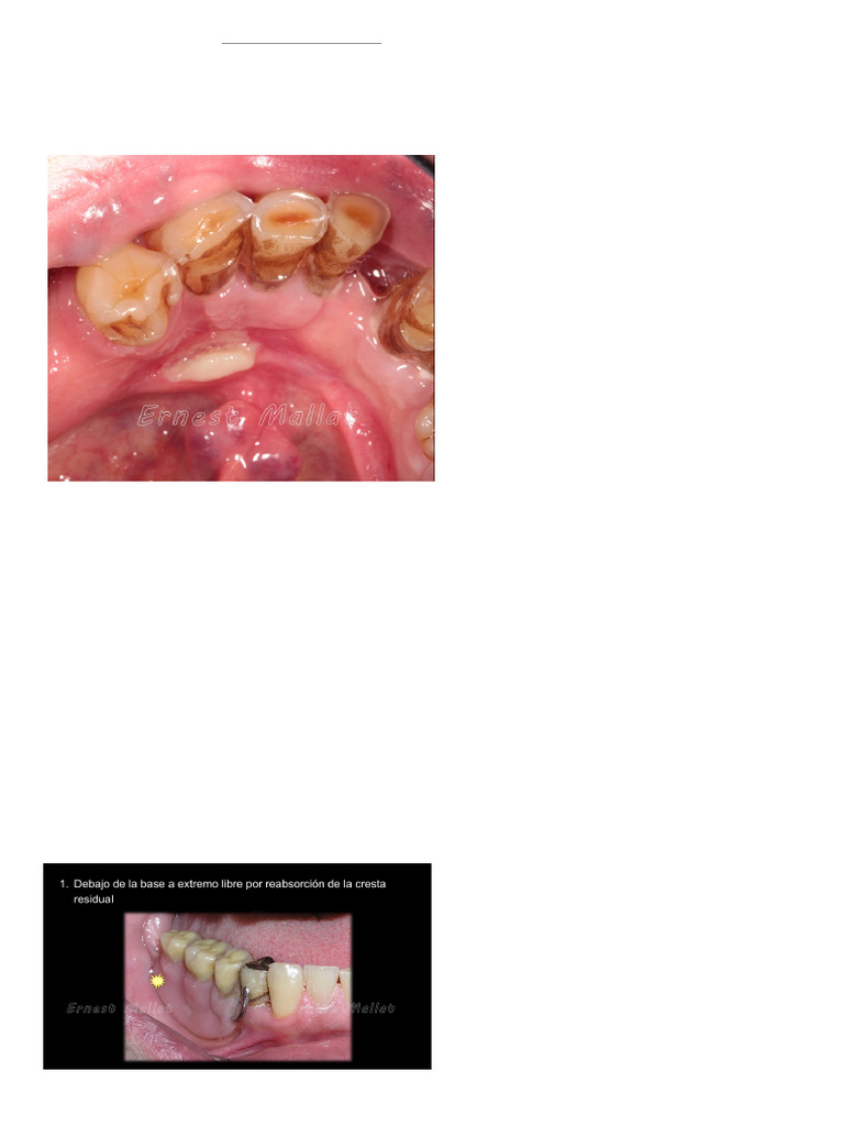 Causas de Ulceraciones Debajo de Las PPR A Extremo Libre - Cómo Resolverlas y Evitarlas (DR ...