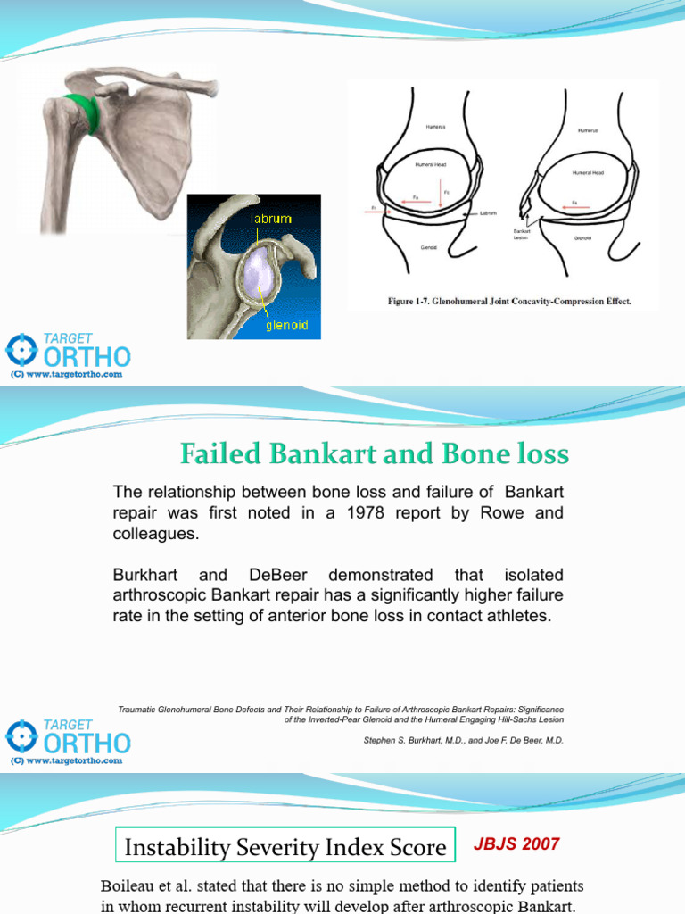 Managing Shoulder Instability With Bone Loss DrMukulpdf ...