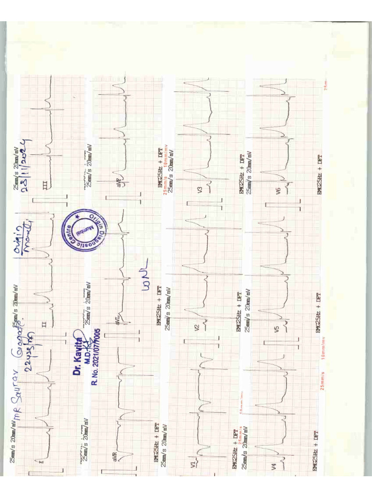 Ecg TMT | PDF