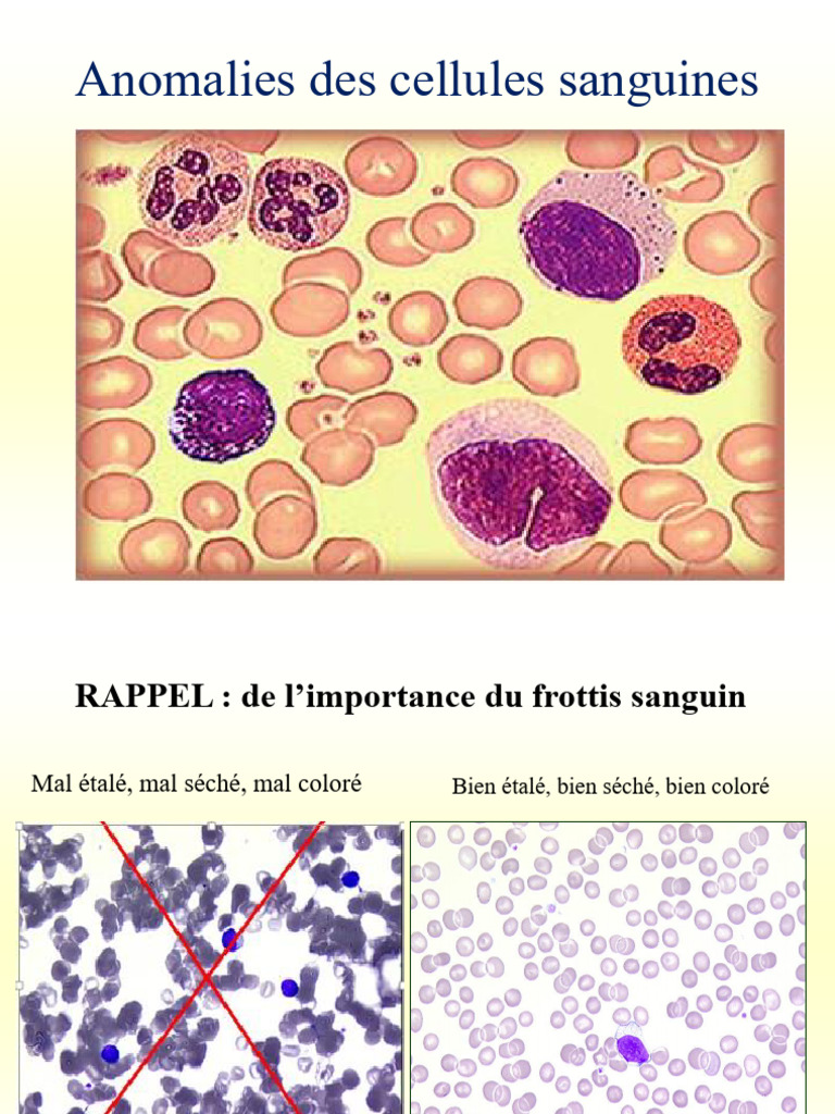 Anomalies des globules rouges en hématologie | PDF | Globule rouge ...
