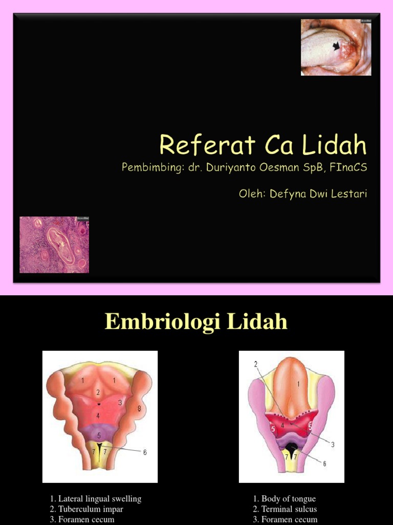 Presentasi Ca Lidah | PDF