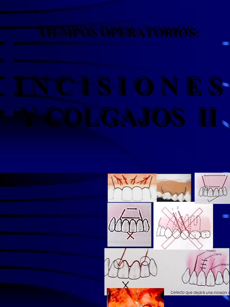 Incisiones y Colgajos en Cirugía Bucal | PDF | Cirugía Oral y Maxilofacial