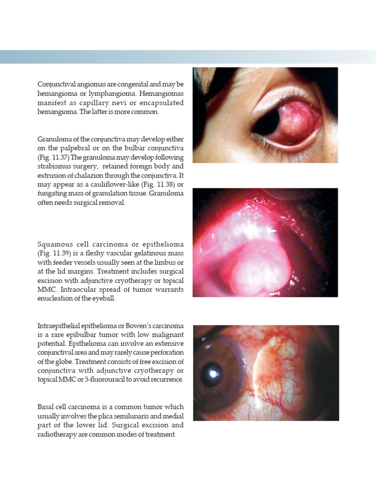 Nema - Textbook of Ophthalmology, 5th Edition-16 | PDF | Cornea | Human Eye