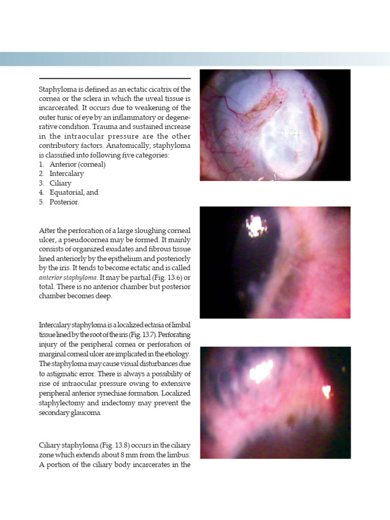 Nema - Textbook of Ophthalmology, 5th Edition-20 | PDF | Cornea ...